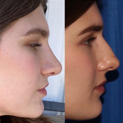 Officially 1 Month And 3 Weeks Post Op Rhinoplasty Rplasticsurgery