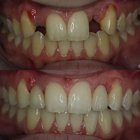 Dental Implants Nyc Top Rated Implant Dentist In Brooklyn Manhattan