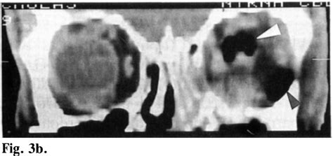Orbital Ct Scans Demonstrating Ethmoiditis And Gas In The Intraconal
