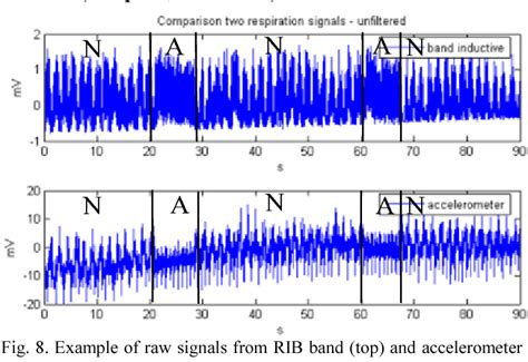Figure 1 From Estimation Of Respiratory Waveform And Heart Rate Using An Accelerometer