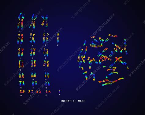 Infertile Male Karyotype Stock Image C0220557 Science Photo Library