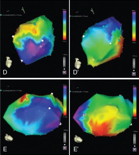Electroanatomic Mapping And Magnetic Guidance Systems Thoracic Key
