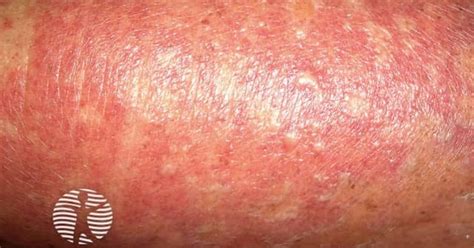 Contact Allergic Dermatitis Of The Arms And Legs Image