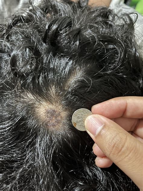 Dark Patch On Scalp Not Raised Or Bumpysize Of Different Coins For