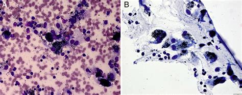 Anthracosis
