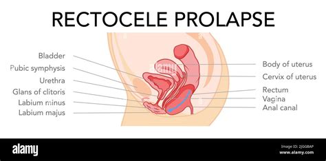 Prolapses Rectocele Female Reproductive System Uterus Diagram With
