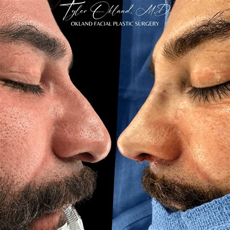 Before And After Gallery In Denver Colorado Okland Facial Plastic Surgery