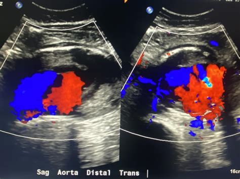 Aaa Screening No Symptoms Rradiology