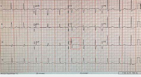 Electrocardiogram Of The Patient At The Time Of Admission With