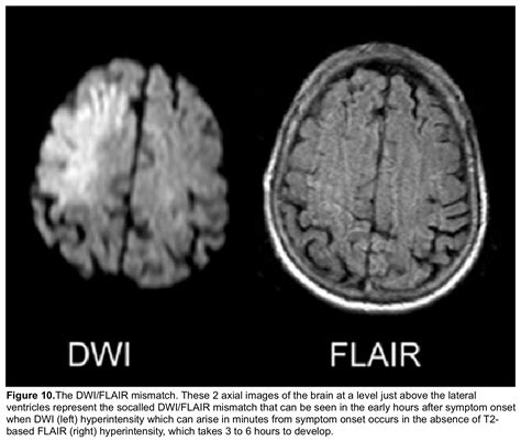 Update On Management Of Acute Ischemic Stroke In The Emergency