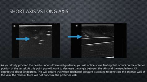 Peripheral Iv Placement Under Ultrasound Guidance Pptx