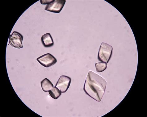 Uric Acid Lowering Therapy May Increase Risk For Ckd Renal And