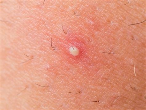 14 Effective Home Remedies For Boils Organic Facts
