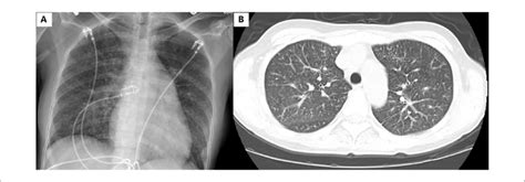 A Chest Radiograph Revealing Mild Diffuse Interstitial Prominence And