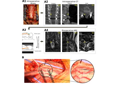 Validation Of Stimulation Location Relative To Dorsal Root Entry Zones