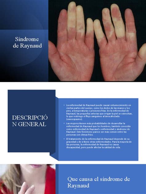 El Síndrome De Raynaud Causas Síntomas Y Tratamiento Pdf