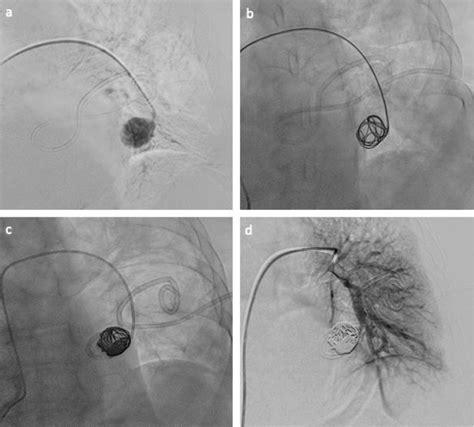 Figure 2 From Endovascular Management Of A Pulmonary Artery
