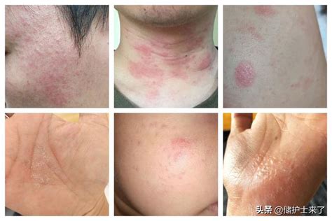 醫生提醒患上濕疹不要驚慌找到原因才是關鍵 每日頭條
