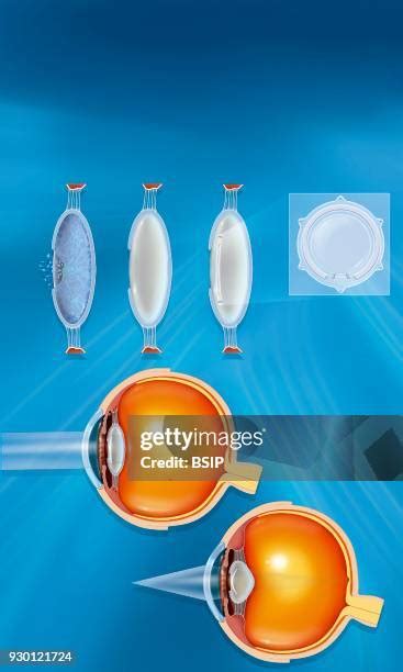 Lens Implant Photos And Premium High Res Pictures Getty Images