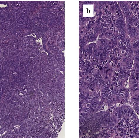 Hysteroscopy Found No Obvious Proliferative Lesion In The Patients