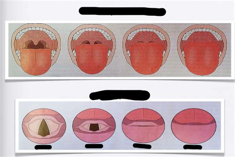 Airway Assessments Diagram Quizlet