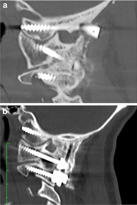 A Sagittal 2d Ct Showing Condylar Screw In Hypoplastic Condyle B