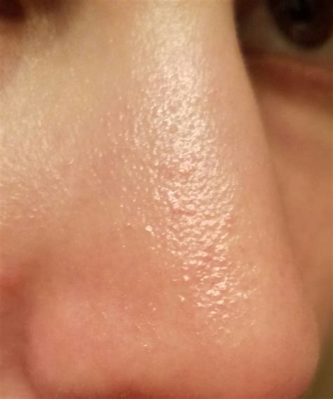 What Are Nose Bumps At Gail Carroll Blog
