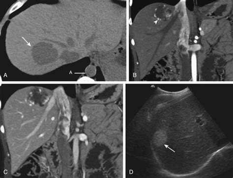 Benign Focal Lesions Clinical Tree