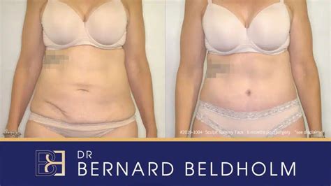 Abdominoplasty Post Pregnancy Before And After