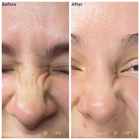 Bunny Lines Treatments Aestiva Clinic