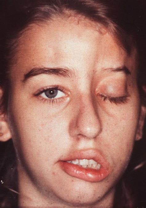 Frontal Linear Scleroderma Dermrounds Dermatology Network