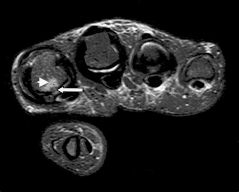 A Enhanced Mri Image Of Metacarpophalangeal Mcp Joints Patient 4
