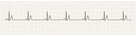Ekg Monitor Showing Sinus Rhythm With Short Qt Interval 36706469 Vector