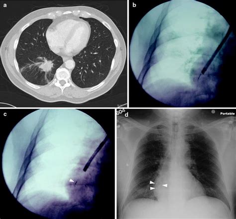 Radiation Therapy And Techniques For Fiducial Placement Radiology Key