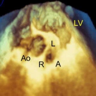 Case 1 A Real Time Three Dimensional Transesophageal Echocardiography