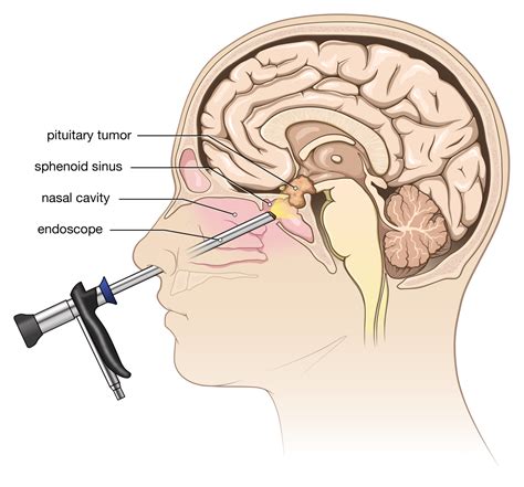 Pituitary Tumor Symptoms And Treatment Goodman Campbell