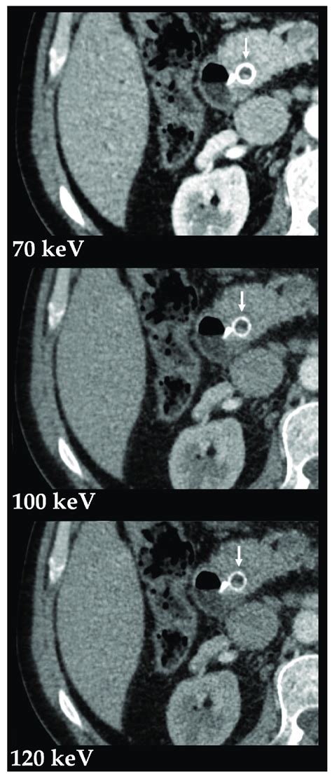 Metal Artifact Reduction With High Energy Vmis Virtual Monochromatic Download Scientific
