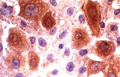 Hsv 1mcintyre Infected Hce Virus Infected Cells Are Stained Brown