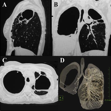 Ct Scan On Admission In Sagittal A Frontal B And Axial C Download Scientific Diagram