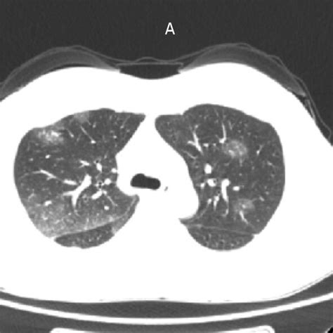 Computed Tomography Of The Chest And Upper Abdomen Reveals Bilateral