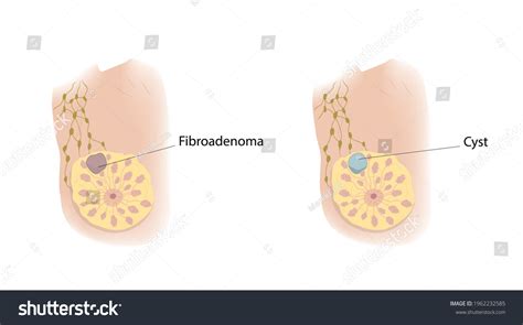 Woman Breast Cyst Fibroadenoma Comparison Medical Stock Vector Royalty