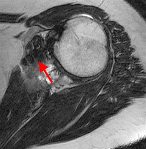 Primary Synovial Chondromatosis Radsource