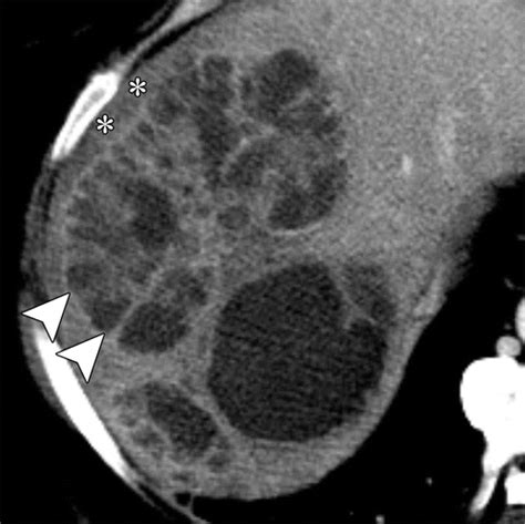 Multidetector Ct Of Emergent Biliary Pathologic Conditions Radiographics