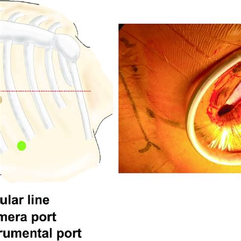 Diagram Of The Surgical Incision And Port Access Position Download Scientific Diagram