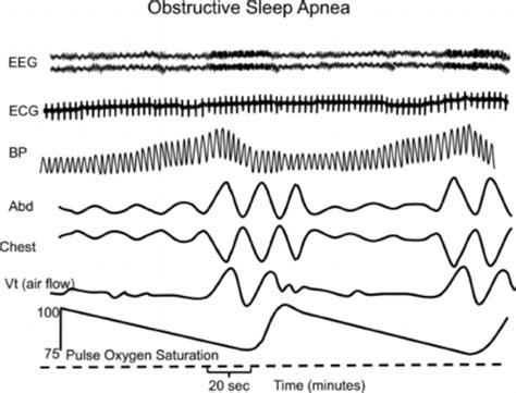 Sleep Disorders Flashcards Quizlet
