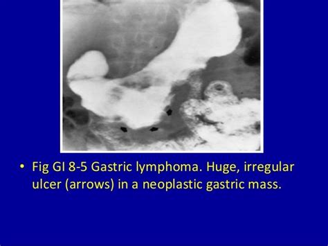 8 Gastric Ulceration