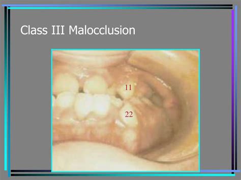Ppt Occlusion Powerpoint Presentation Free Download Id6736052