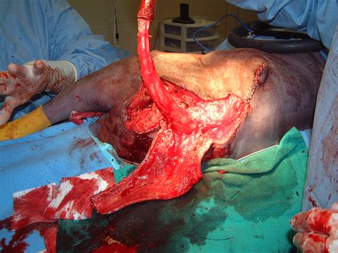 Reconstruction Axial Pattern Flaps — Dr Julius M Liptak