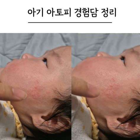 아기아토피크림 원인부터 촉촉하게 아기피부건조 경험담 네이버 블로그