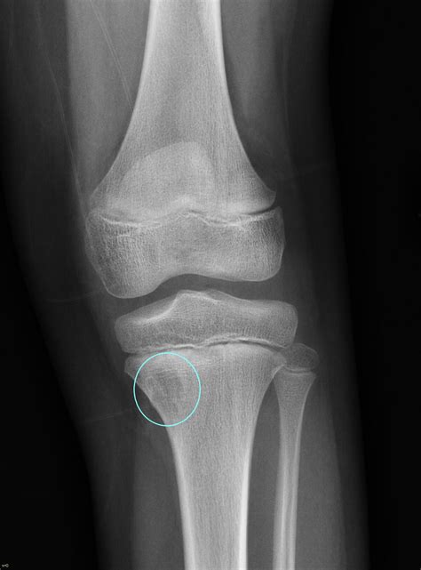 Radiopaedia Case Fibrous Cortical Defect Id 42462 Study 45583 Nc